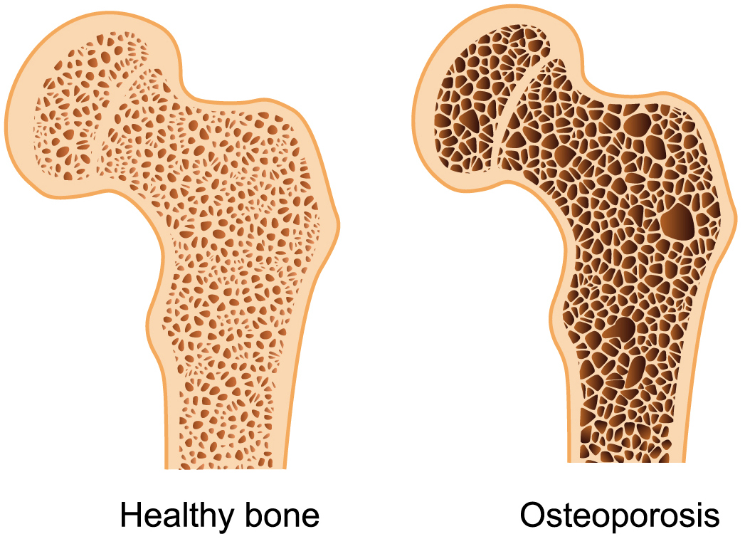 Osteoporosis Diary Of A Caribbean Med Student Osteoporosis Diary Of A Caribbean Med Student